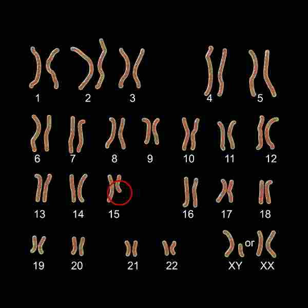 Prader Willi Syndrome